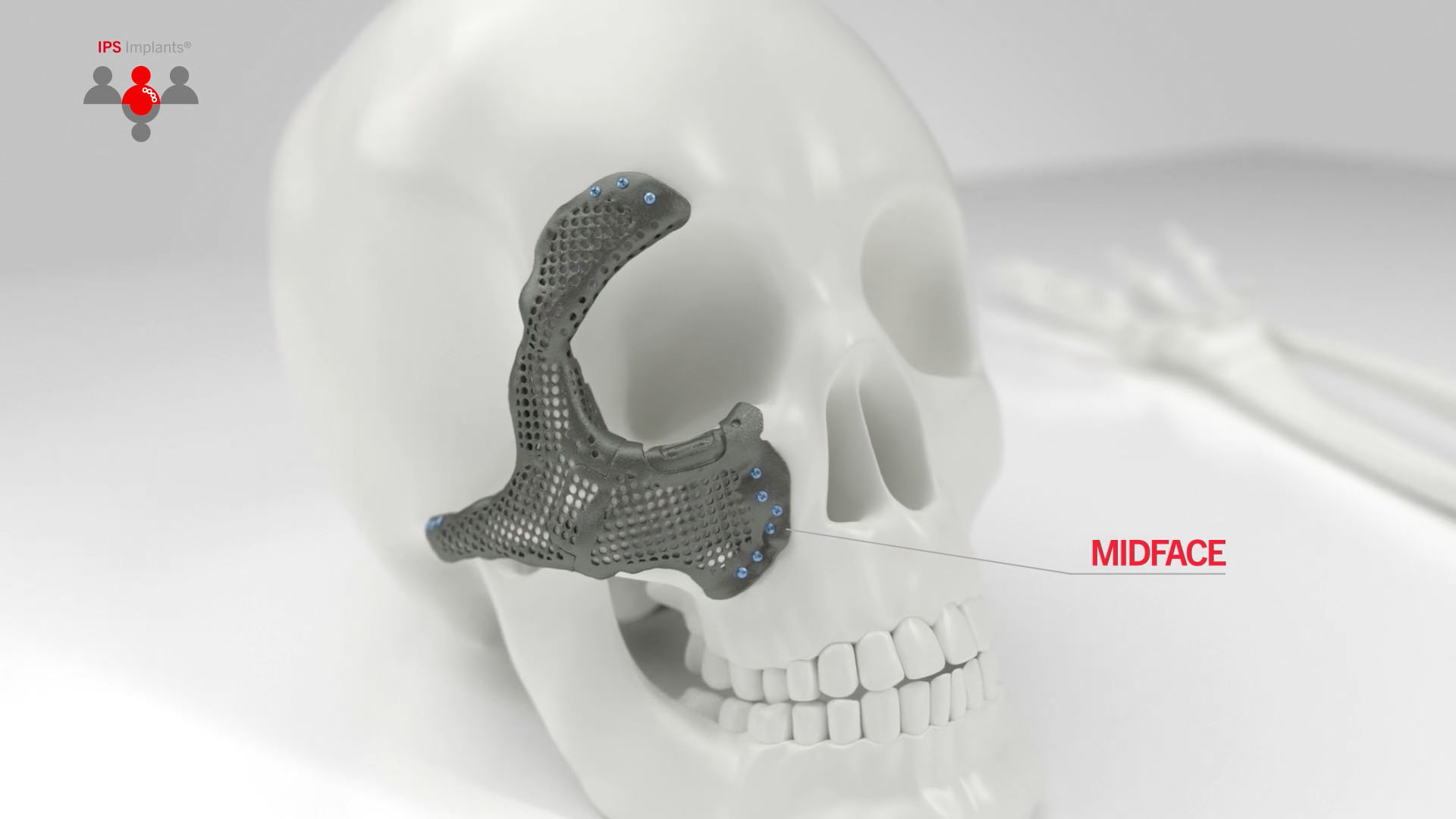 KLS Martin Group - IPS - DEJO-Media